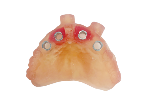 Digital Implant Guide - Surgical Guide by Minimax Implant