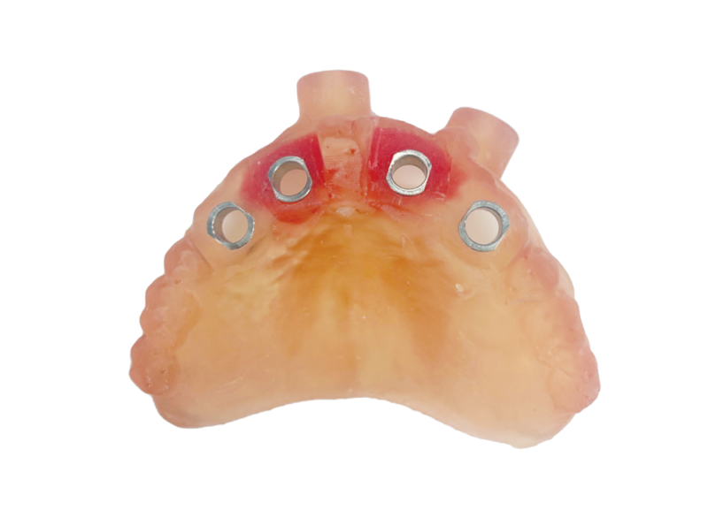 Digital Implant Guide - Surgical Guide by Minimax Implant